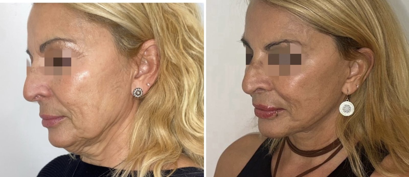 Lifting Facial ADS - Expertos en Cirugía Plástica Facial