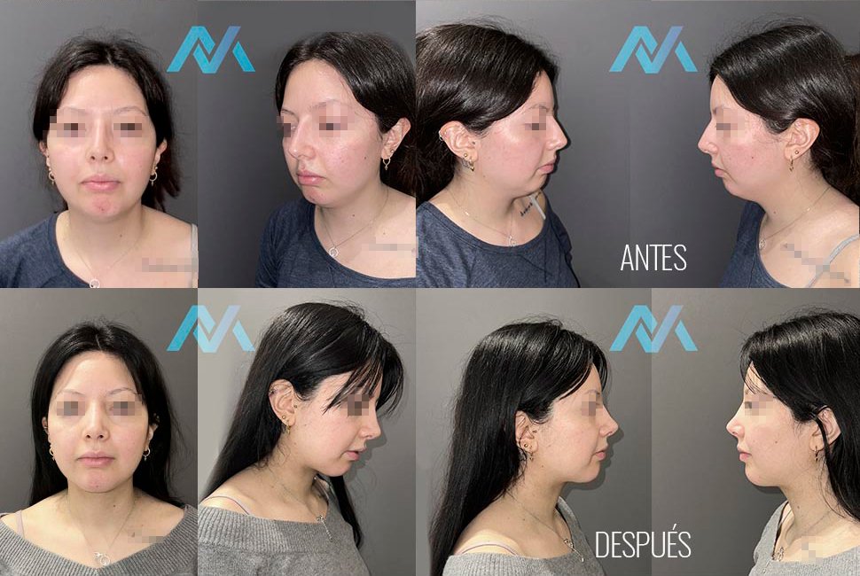 rejuvenecimiento facial ads - Expertos en Cirugía Plástica Facial